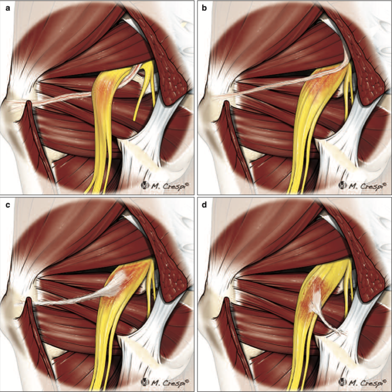Piriformis-Syndrom: Ursachen, Symptome und effektive Behandlung - Hüftcoach